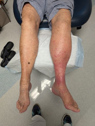 Lymphedema – Salem Surgical